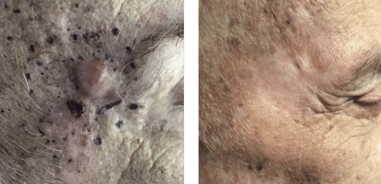 Superficial Radiation Therapy (IG-SRT) Washington | Oregon SRT