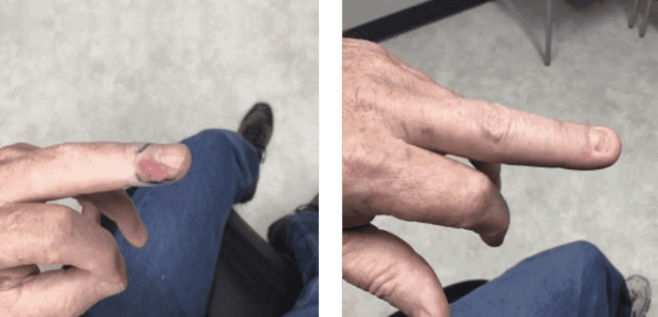 Superficial Radiation Therapy (IG-SRT) Washington | Oregon SRT